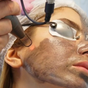 Carbon Facial – FaBesthetics Laser Skincare Mahopac, NY